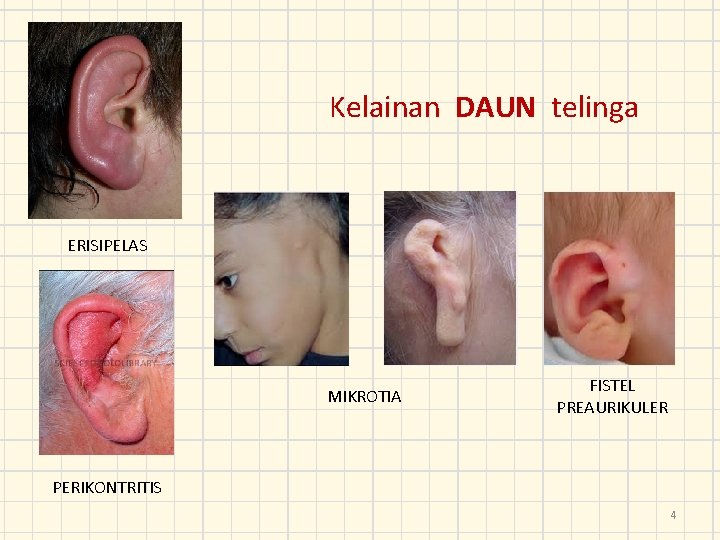 REVIEW pra UTS 1 KELAINAN TELINGA Labirinitis Meniere