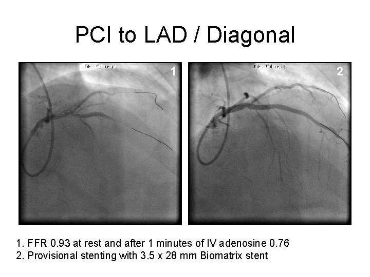 OCT bifurcation stenting Ashish Shah 1 Rito Mitra