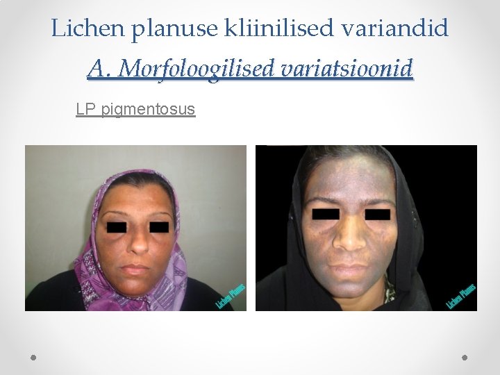 Lichen ruber planus klassifikatsioon ja kliiniline leid Koostaja