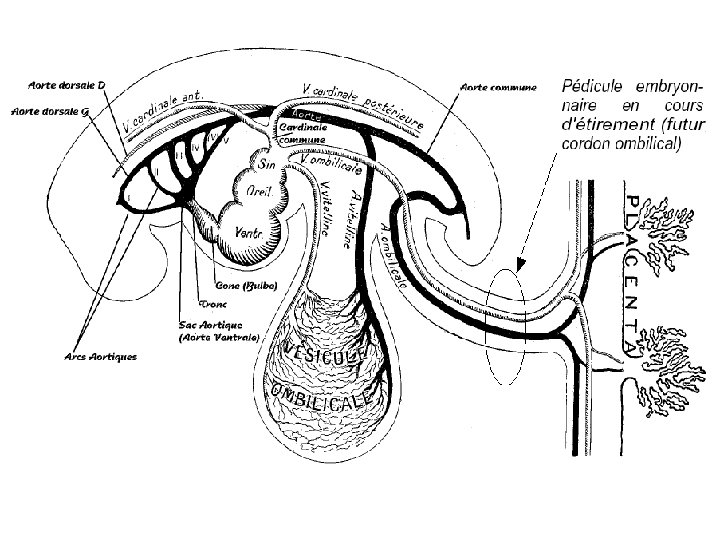 Diverticule de Meckel Prsent par Dr L BAHRI
