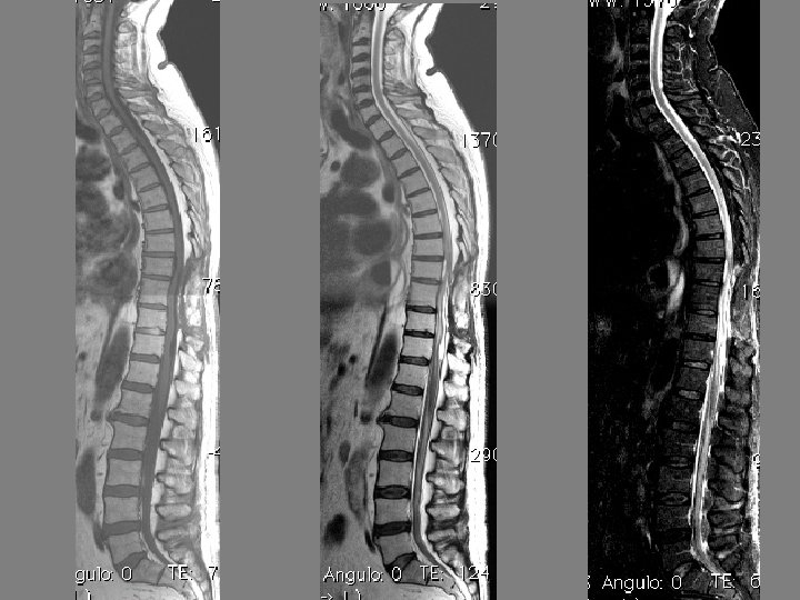 tcnica Tcnica RM de columna completa Se propone