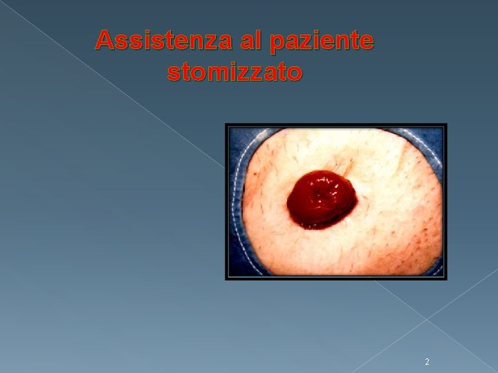 Gestione delle stomie Stoma Care Il termine stomia
