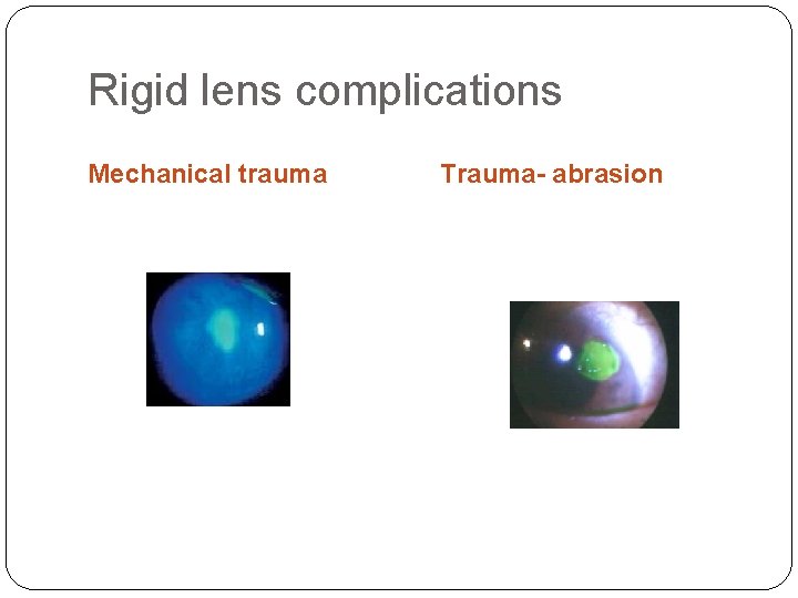 Rigid lens complications Week 12 Rigid lens complications