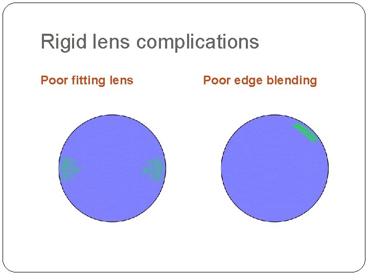 Rigid lens complications Week 12 Rigid lens complications