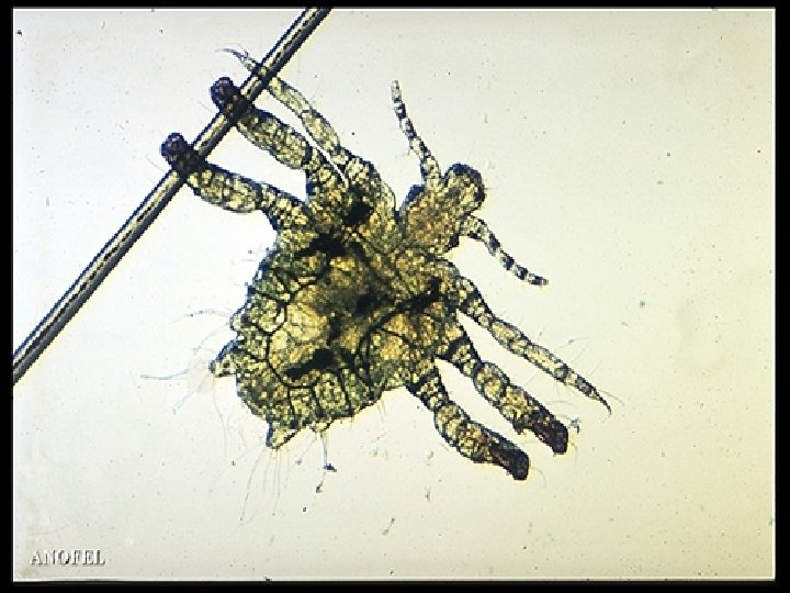 Pdiculose Dr A TITI 2013 3 types Pdiculose