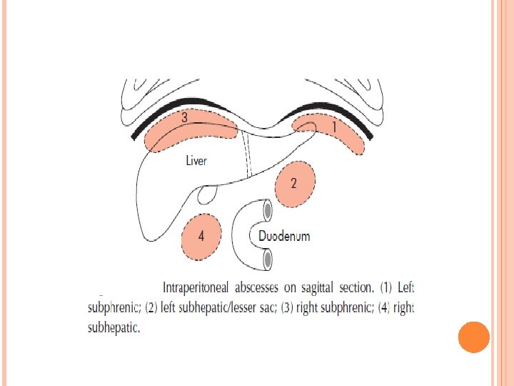 ABDOMINAL AND PELVIC ABSCESSES Abscess formation following local