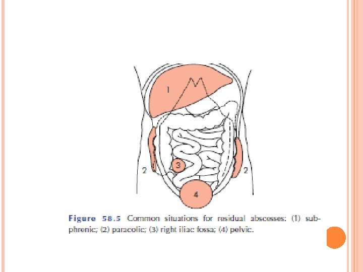 ABDOMINAL AND PELVIC ABSCESSES Abscess formation following local