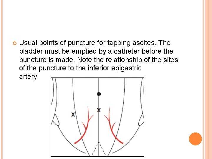 ABDOMINAL AND PELVIC ABSCESSES Abscess formation following local