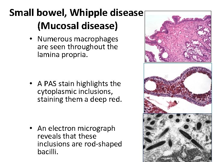 Gastrointestinal Block Pathology lecture 2013 Malabsorption Dr Maha