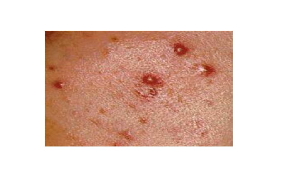 Dermatologie de lenfant Dr boufres rima Pdiatrie A