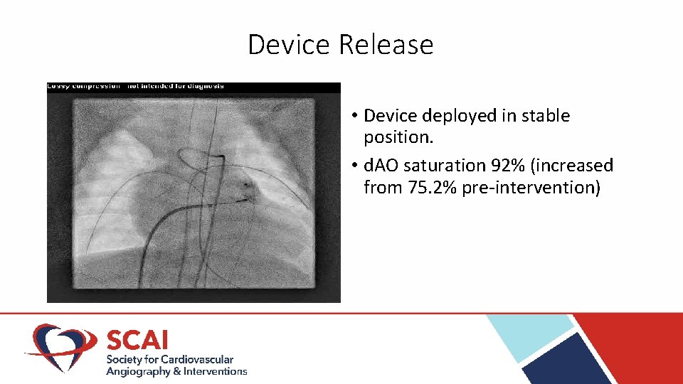 Surgical Shunts Causing Circular Shunt An Approach to