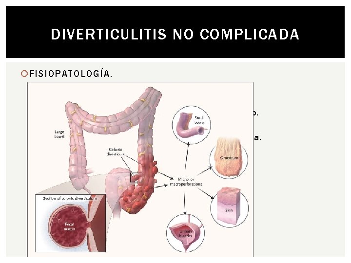 ENFERMEDAD DIVERTICULAR Dr Juan Pablo Carrizales Luna Residente