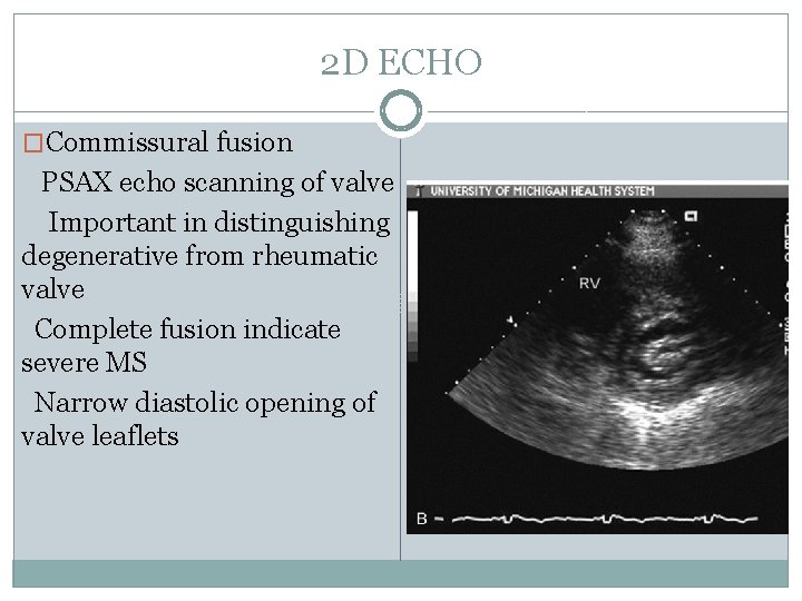 ECHOCARDIOGRAPHY IN MITRAL STENOSIS DR RAJESH K F