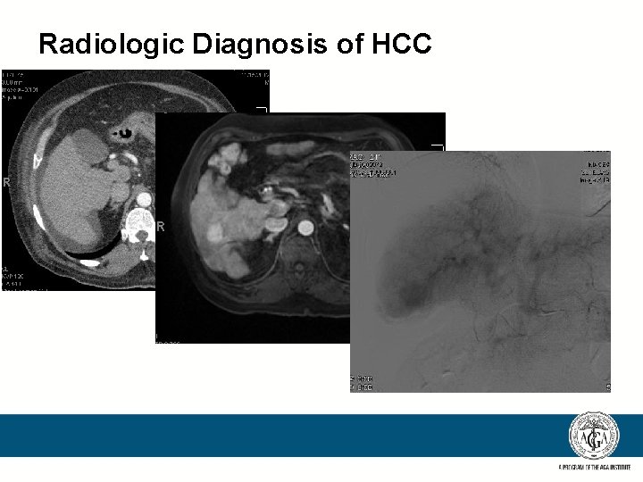 Primary Liver Cancer Hepatocellular Carcinoma and Cholangiocarinoma Patrick
