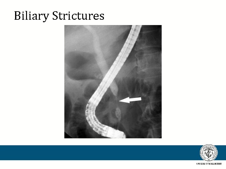 Primary Liver Cancer Hepatocellular Carcinoma and Cholangiocarinoma Patrick