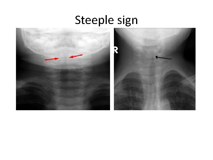 Stridor in Children Dr Montaha ALIede MD DCH