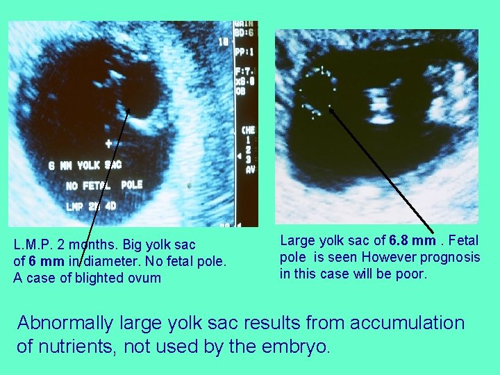 Predictive Value of Yolk Sac in Early Pregnancy