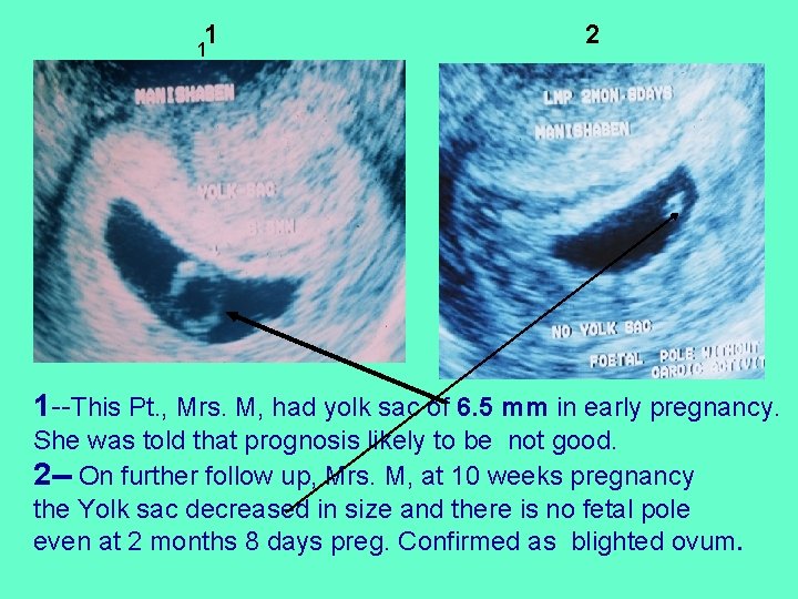 Predictive Value of Yolk Sac in Early Pregnancy