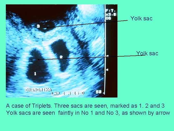 Predictive Value of Yolk Sac in Early Pregnancy