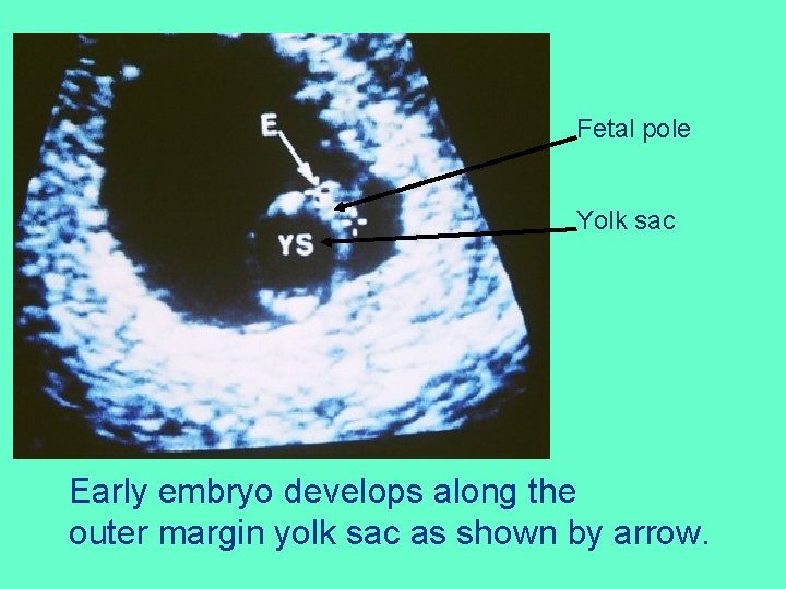 Predictive Value of Yolk Sac in Early Pregnancy