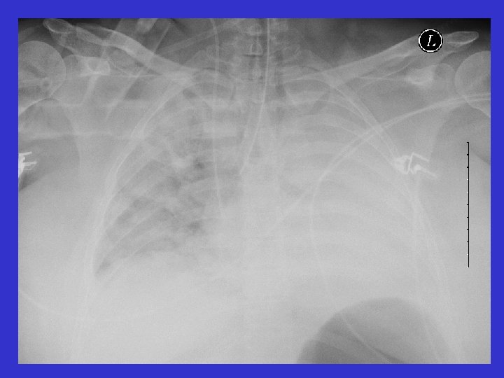 ARDS Acute Lung Injury Adult Respiratory Distress Syndrom