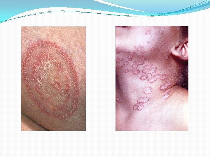 Dermatophytes Dermatophytes are a group of closely related