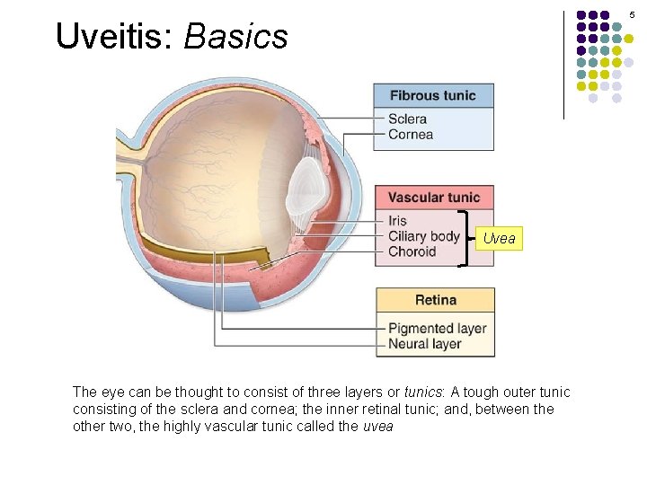 Uveitis Basics What is uveitis Uveitis Basics What