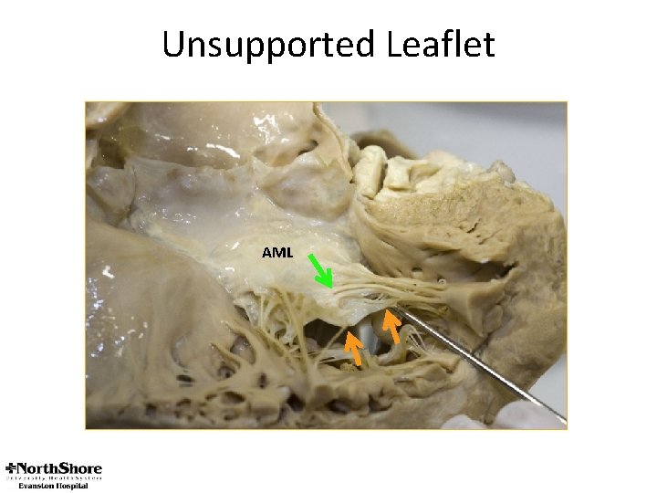 What Are the Limitations of the Mitra Clip