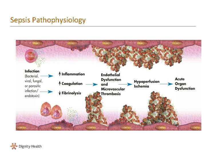 Incidence Definitions Pathophysiology Prevalence of Severe Sepsis Septic