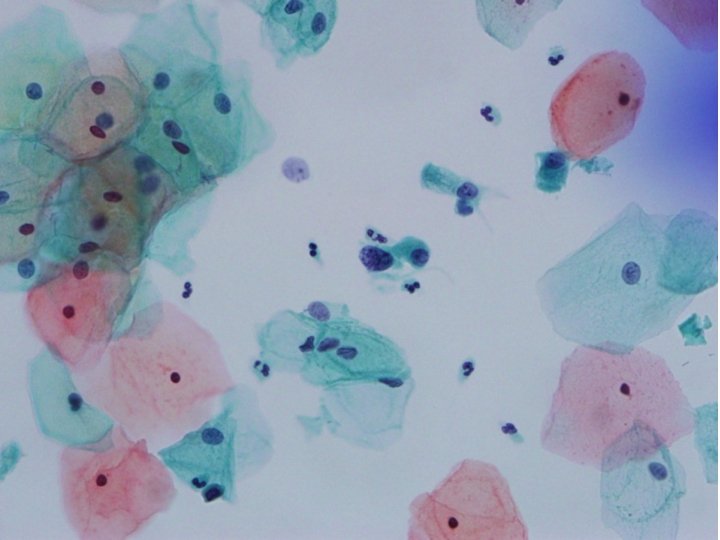 Cytologic Findings Clusters of hyperchromatic crowded columnar cells