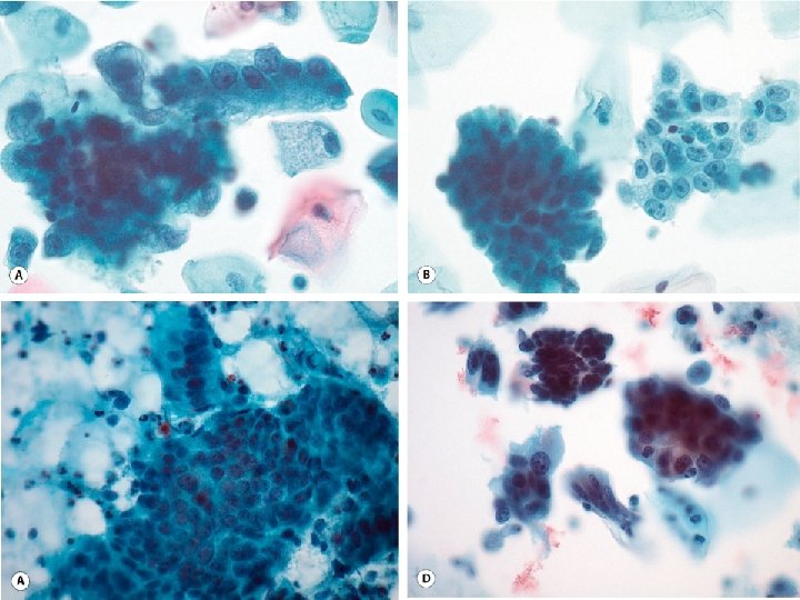 Cytologic Findings Clusters of hyperchromatic crowded columnar cells
