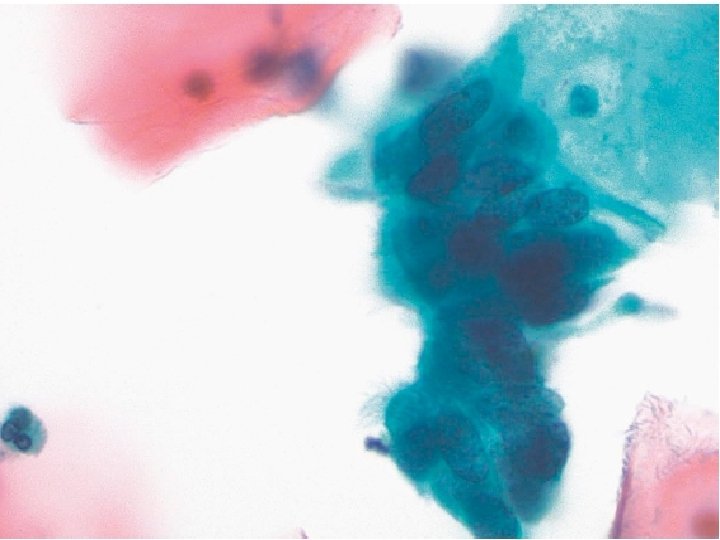 Cytologic Findings Clusters of hyperchromatic crowded columnar cells