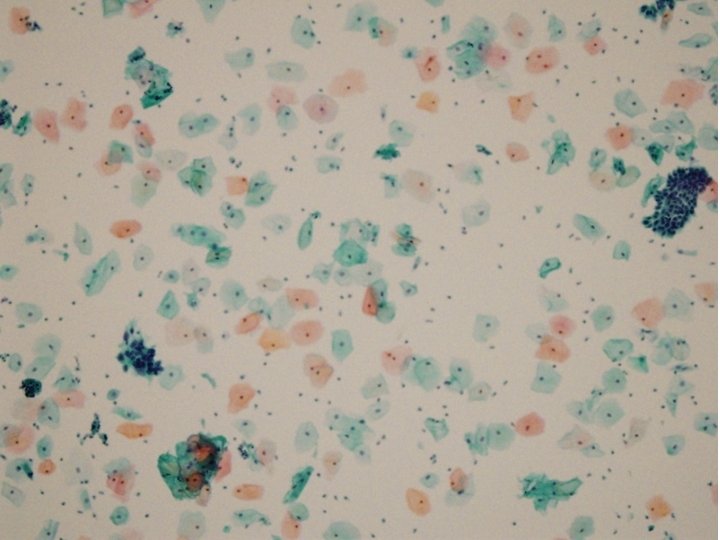Cytologic Findings Clusters of hyperchromatic crowded columnar cells