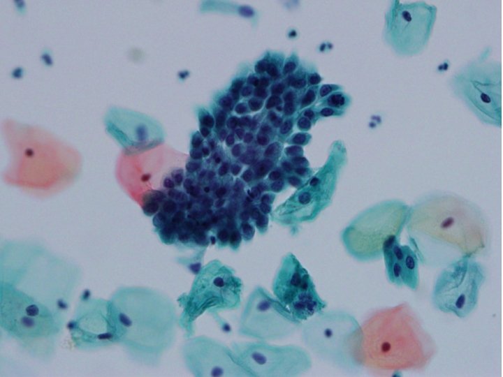 Cytologic Findings Clusters of hyperchromatic crowded columnar cells