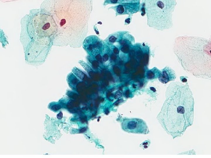 Cytologic Findings Clusters of hyperchromatic crowded columnar cells