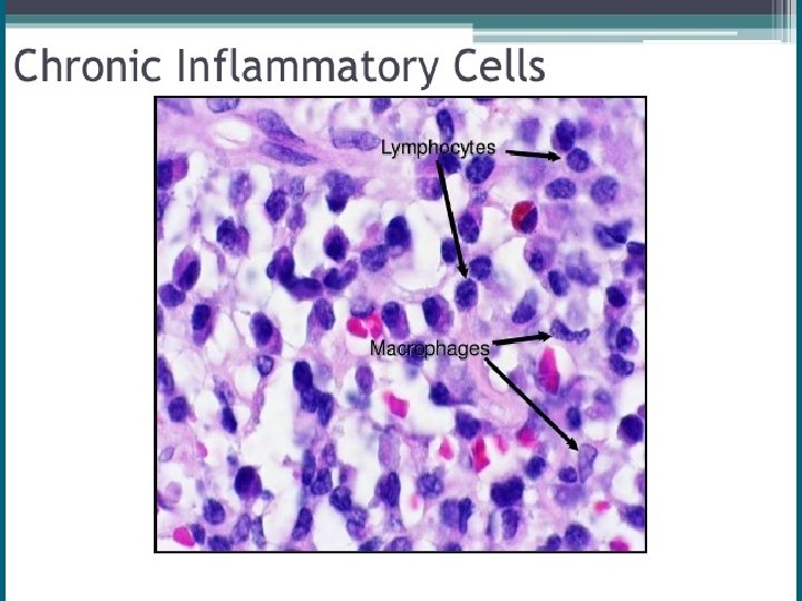 CHRONIC INFLAMMATION DR RABIA RATHORE ASSISTANT PROFESSOR WEST