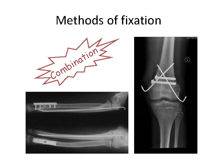 Common Pediatric Fractures and Trauma Prof Mohamed Zamzam