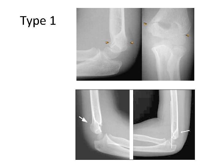 Common Pediatric Fractures and Trauma Prof Mohamed Zamzam