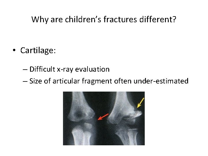 Common Pediatric Fractures and Trauma Prof Mohamed Zamzam