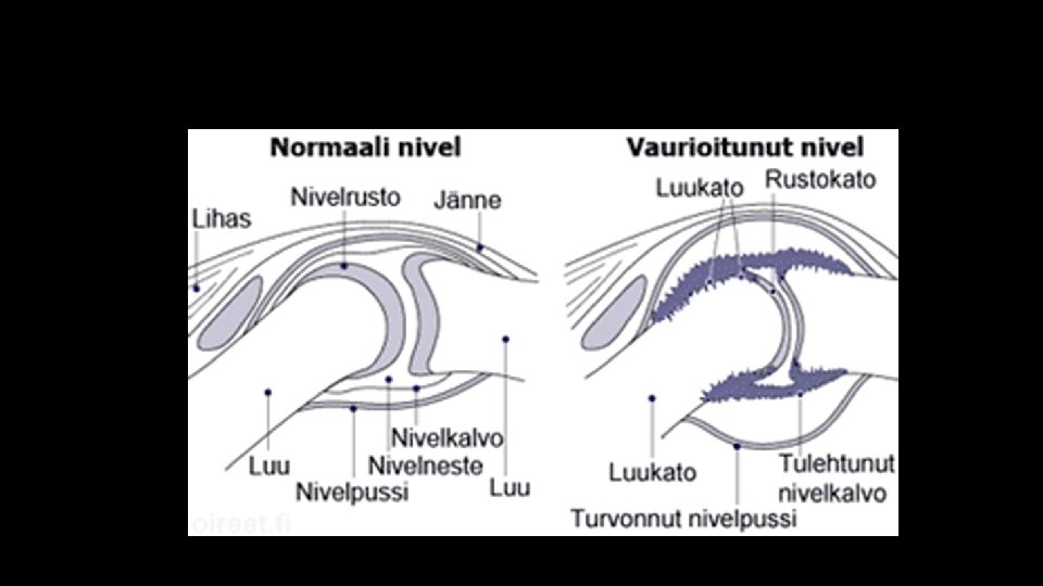 Nivelreuma ja nivelrikko Venla Sonja ja Marianne Nivelreuma
