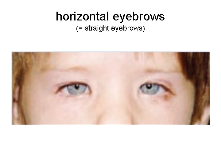 Elements of Morphology Standard Terminology for the Periorbital