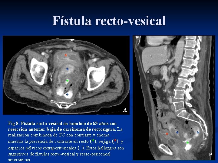 Hallazgos radiolgicos en la tomografa computarizada tras la