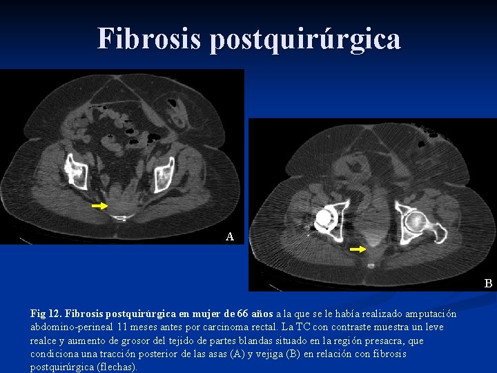 Hallazgos radiolgicos en la tomografa computarizada tras la
