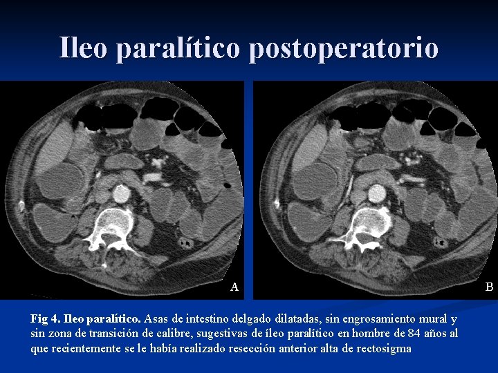 Hallazgos radiolgicos en la tomografa computarizada tras la