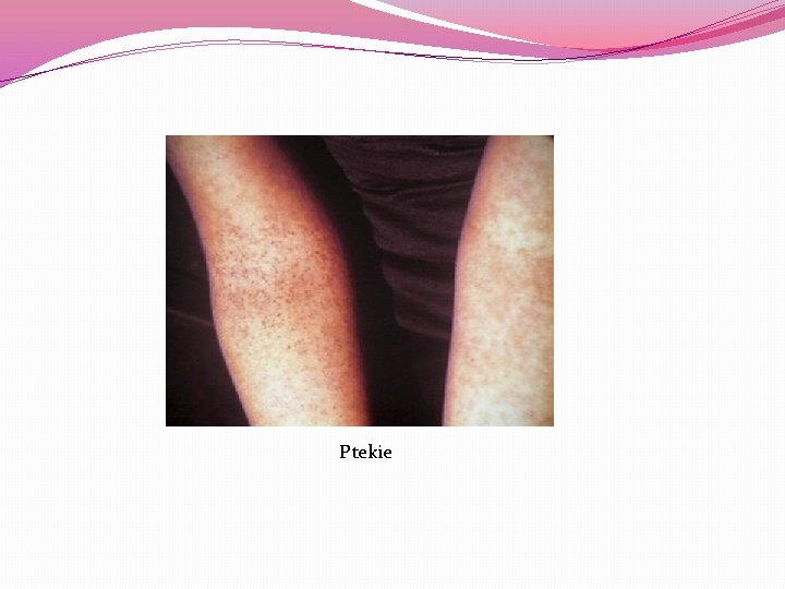 DEMAM BERDARAH DENGUE Nur Auliyah Firdaus S ST