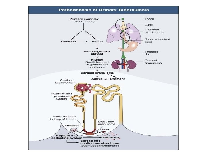Tuberculosis of the Urinary Tract MN Definition Genitourinary
