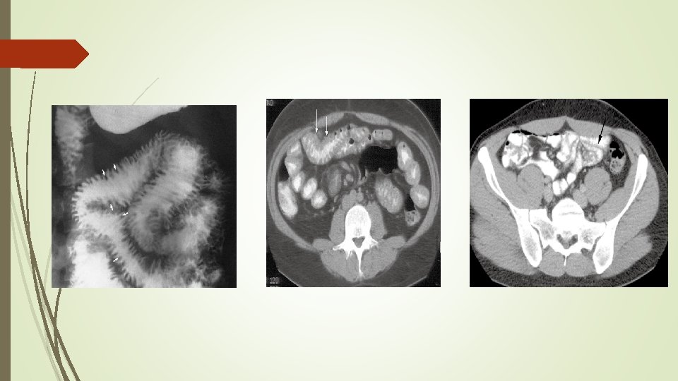 Radiology of common GIT Diseases Dr Sultan Alharbi