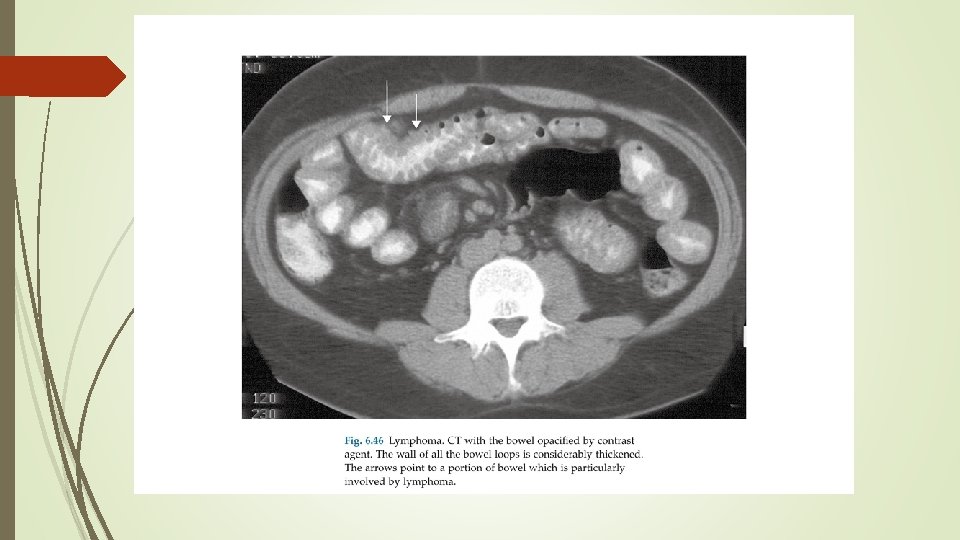 Radiology of common GIT Diseases Dr Sultan Alharbi