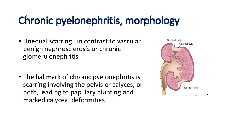 Tubulointerstitial diseases urolithiasis Ali Al Khader M D