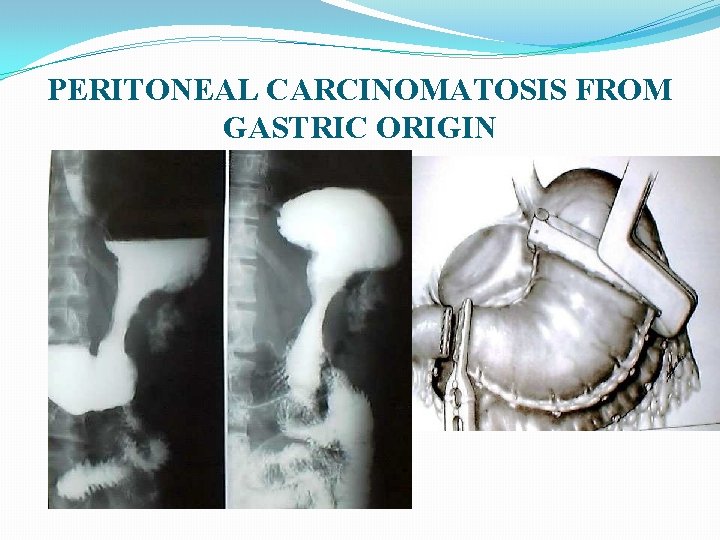 Peritoneal Nodules and Cytoreductive Surgery By dr Ahmed